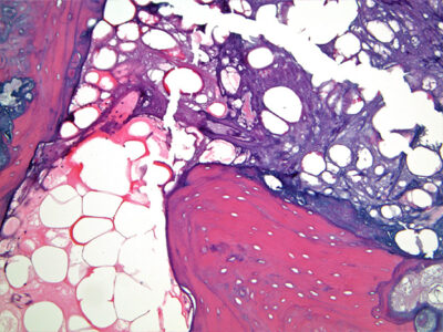 Bone (Orthopaedic) Pathology | Cleveland Clinic Laboratories