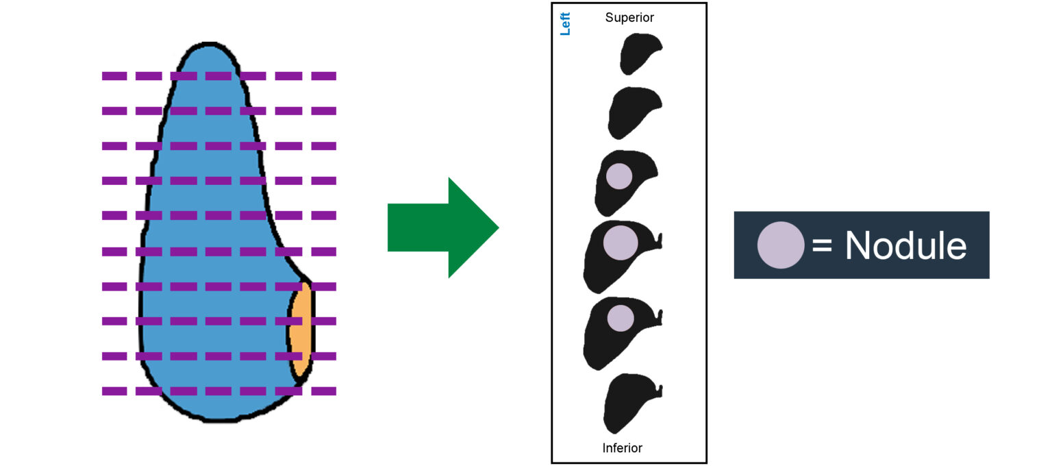 Thyroid Grossing Guidelines | Cleveland Clinic Laboratories